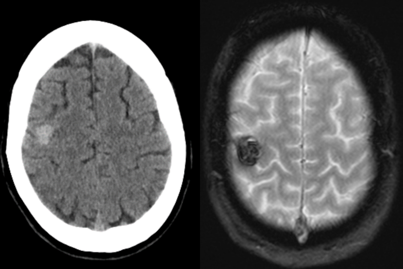 Experiencing the Spectrum of Care: From Patient To Nurse in the NeuroICU